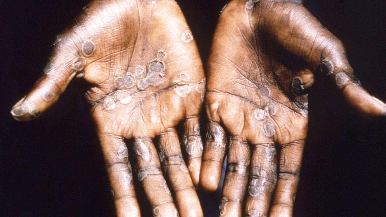 WHO: Festivalsæson kan forstærke udbrud af abekopper i Europa ...