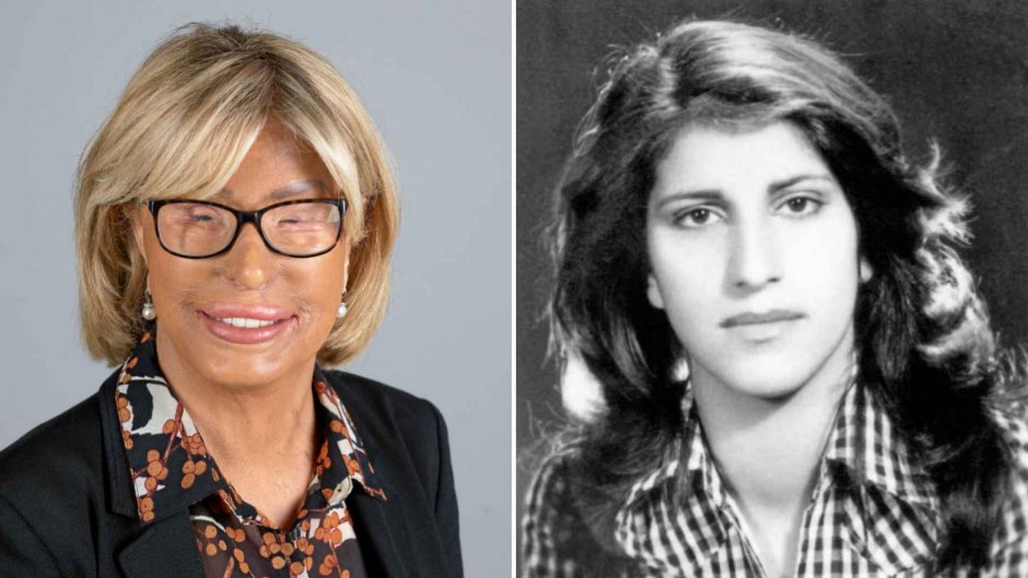 Maria Rashidi blev angrebet med syre, da hun ville skilles: Nu hjælper ...